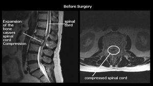 Complex Spine Surgery Melbourne | Spine Surgery Melbourne
