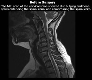 Advanced Spine Surgery Australia |Complex Spine Surgery Richmond