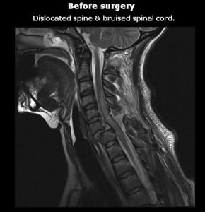 Complex Spine Surgery Melbourne | Spine Surgery Melbourne