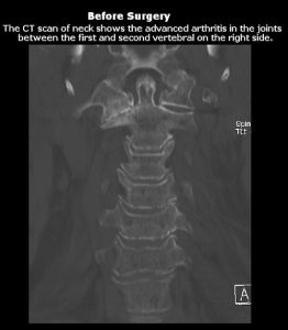 Complex Spine Surgery Melbourne | Spine Surgery Melbourne