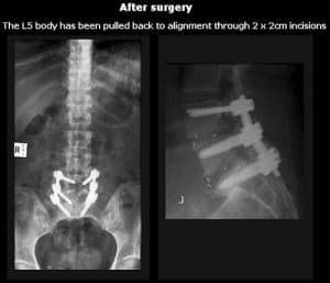 Keyhole Spine Surgery | Minimally Invasive Spine Surgery